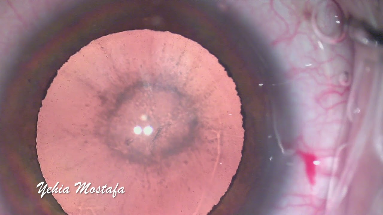Anterior capsulorhexis in posterior subcapsular cataract - YouTube