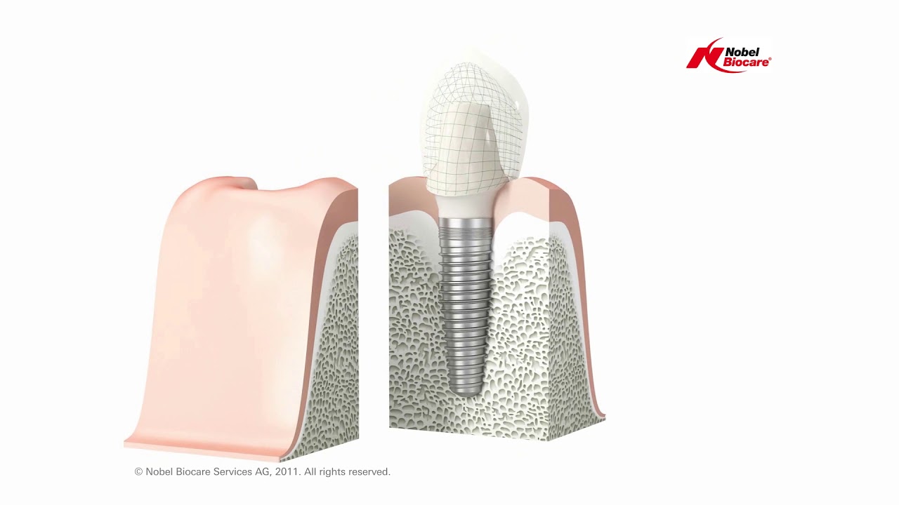 Dental Implants Nobel Biocare Single Tooth Implant 1080p - YouTube