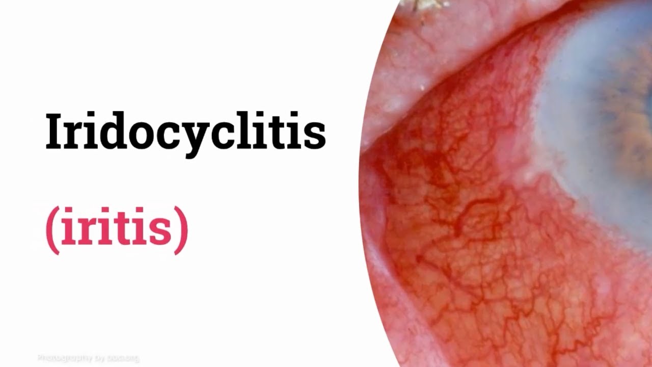 Iridocyclitis iritis - YouTube