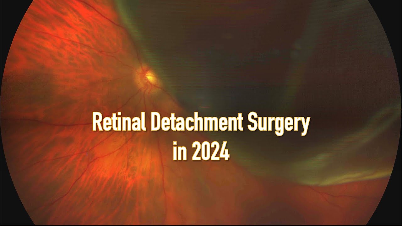 Video example of retinal detachment surgery in less than a minute - YouTube
