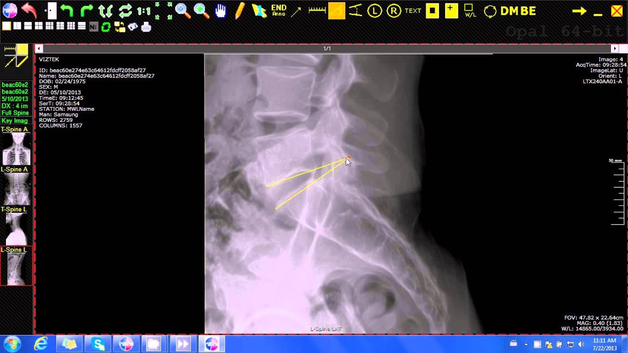 20/20 Imaging Opal-Rad (Chiropractic) Angle measurement tool - YouTube