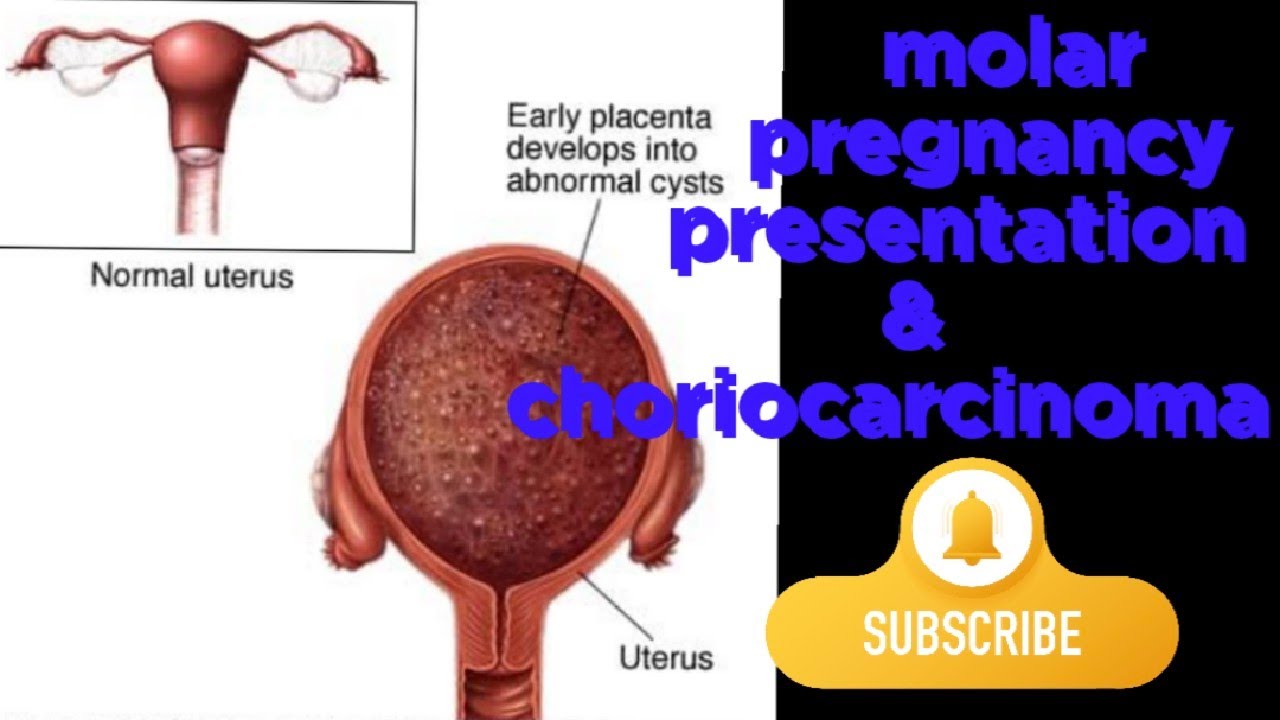 Molar Pregnancy Presentation Choriocarcinoma Youtube