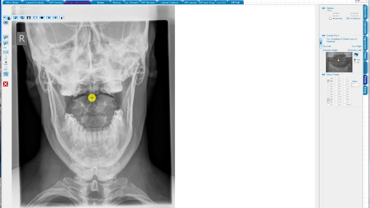 APOM - CBP Technique - YouTube