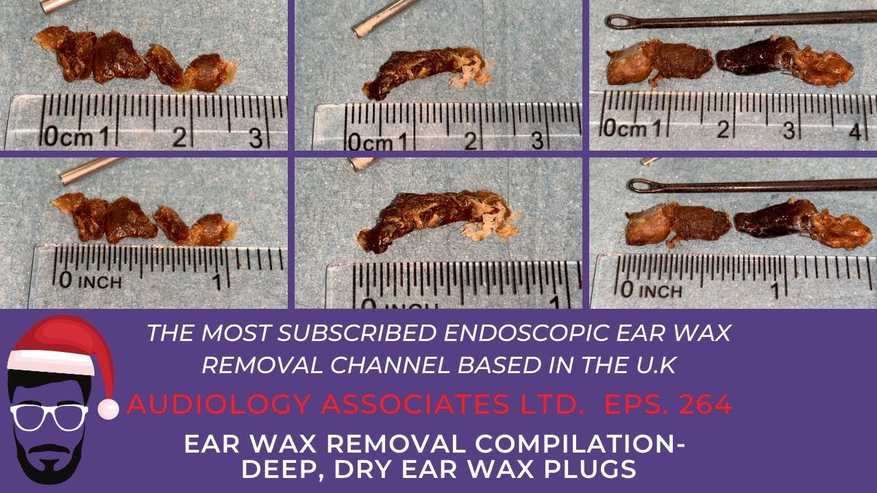 EAR WAX REMOVAL COMPILATION - DEEP DRY EAR WAX PLUGS - EP 264 - YouTube