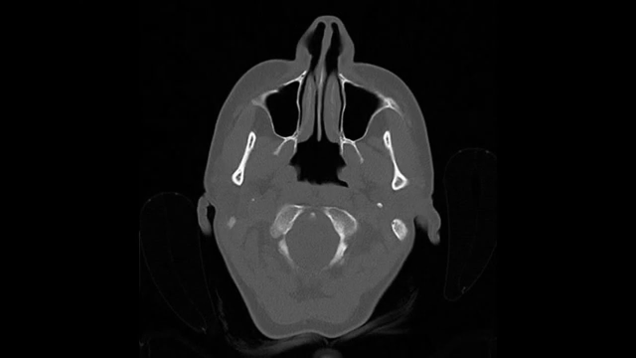 CT Scan, Sinuses - 3rd Feb 2016 - YouTube