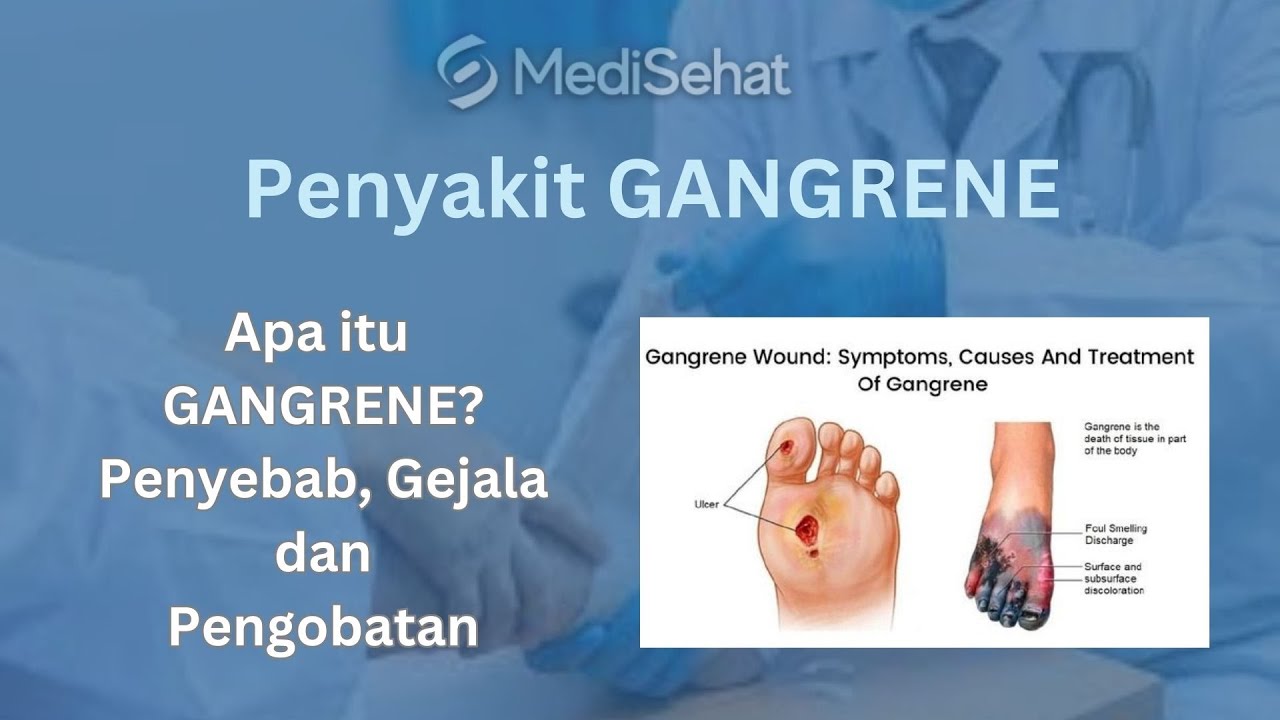 GANGRENE - Penyebab, Gejala dan Cara Mengobati #berobatkepenang # ...