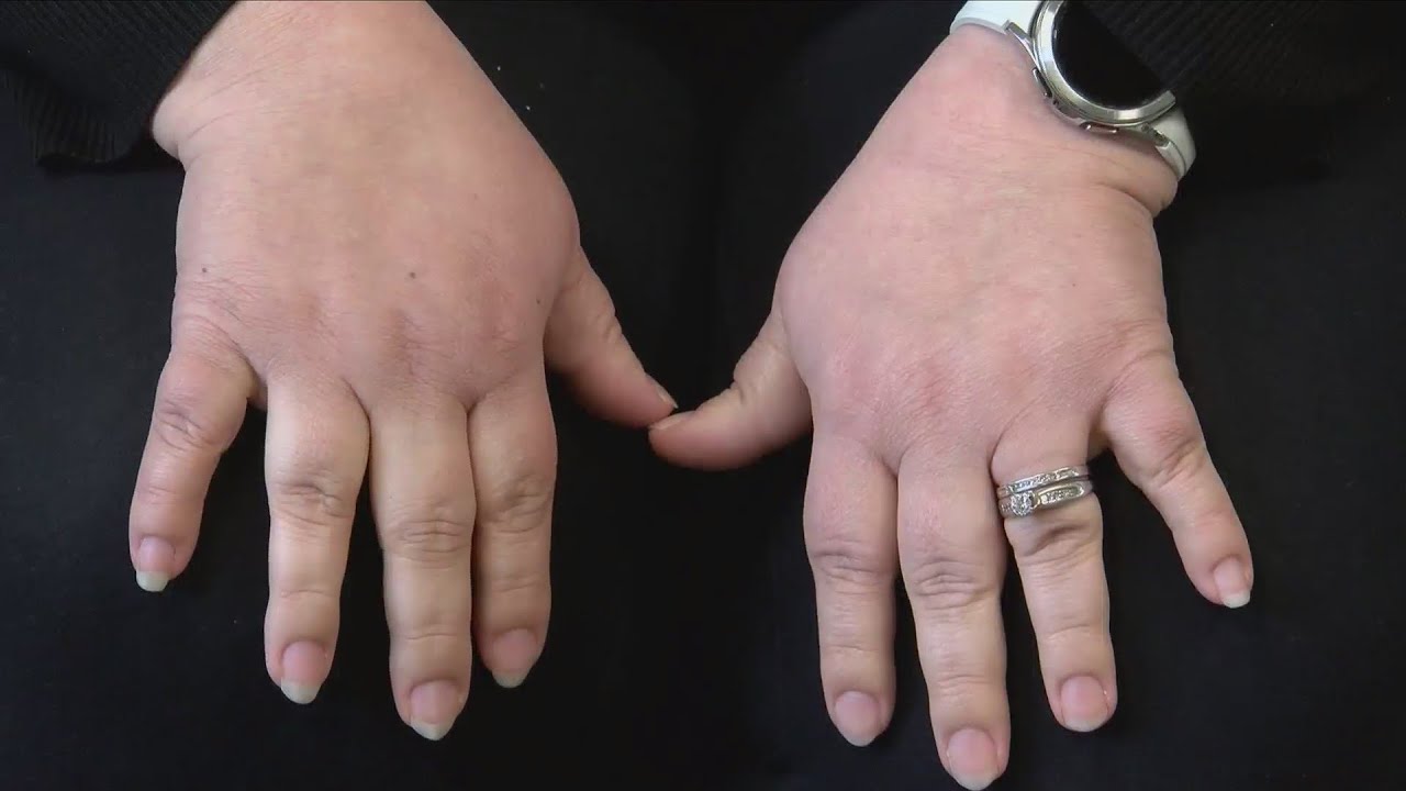 DAVENPORT WOMAN LIVING WITH ACROMEGALY - YouTube