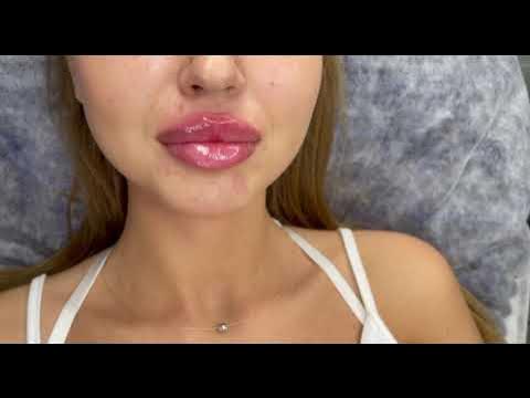 Увеличение губ видео процесса 18 - YouTube
