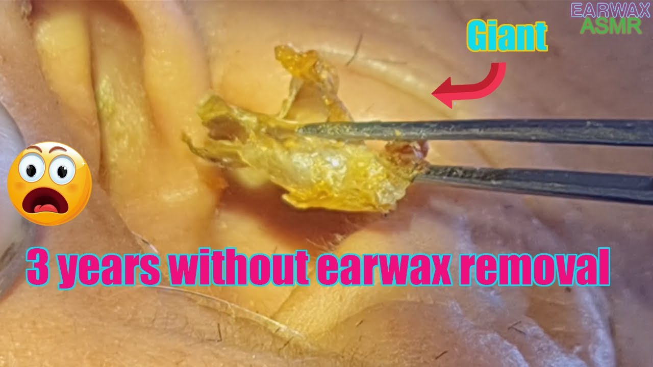 3 years without earwax removal and the results. He always complained ...