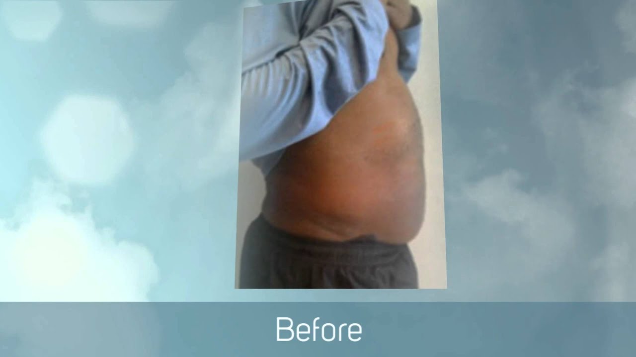 Cellulite Reduction Vero Beach Florida - YouTube