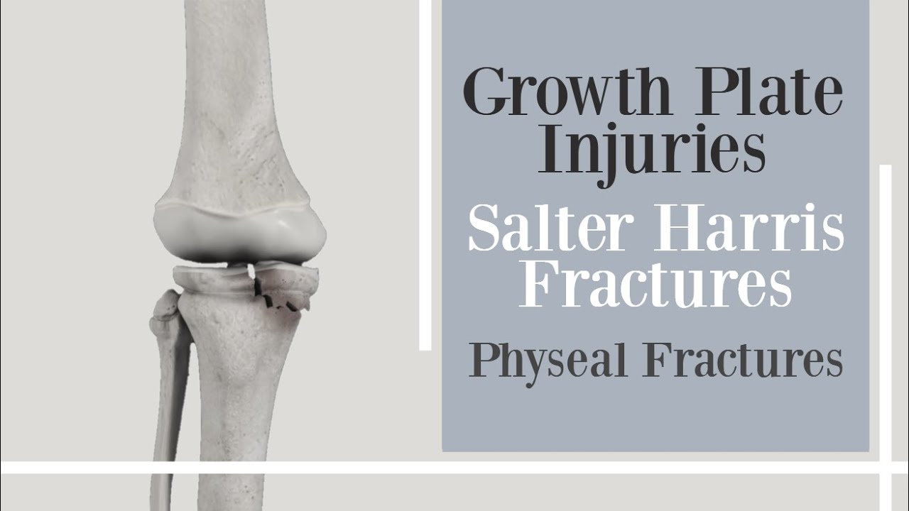 growth plate injury: Physeal Fracture , Salter Harris Fracture - YouTube