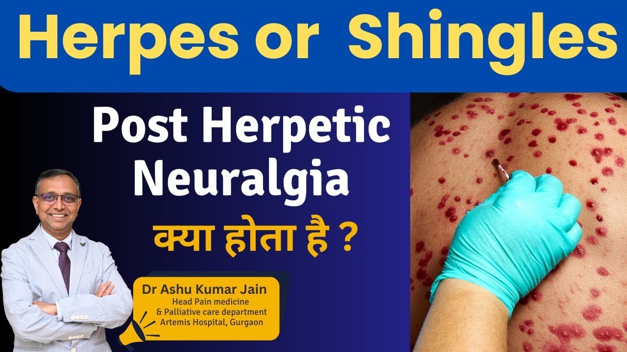 NERVE PAIN AFTER SKIN RASH? | Post Herpetic Neuralgia | Herpes or ...