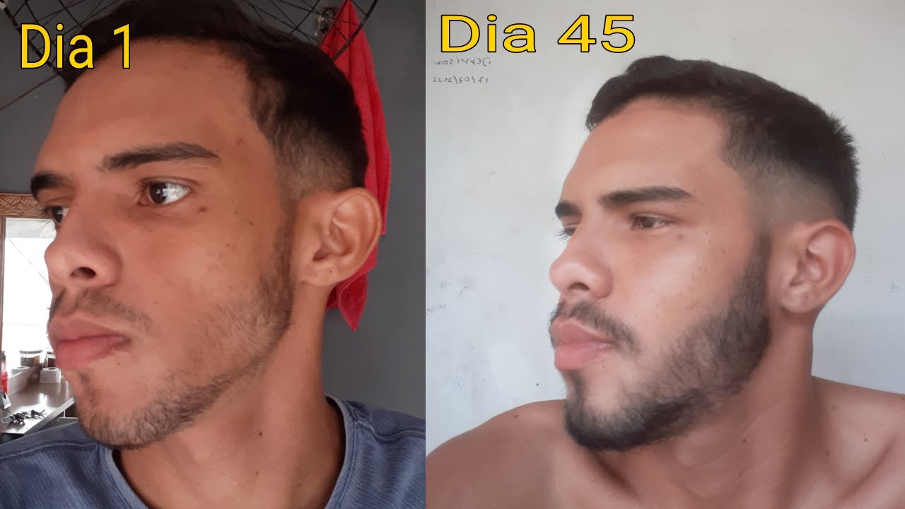 Minha evolução de 1 mês e 15 dias usando MINOXIDIL - YouTube