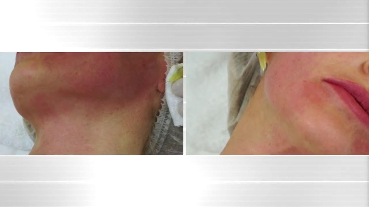 Использование RegenLab Plus & Regen Cellular Matrix - YouTube