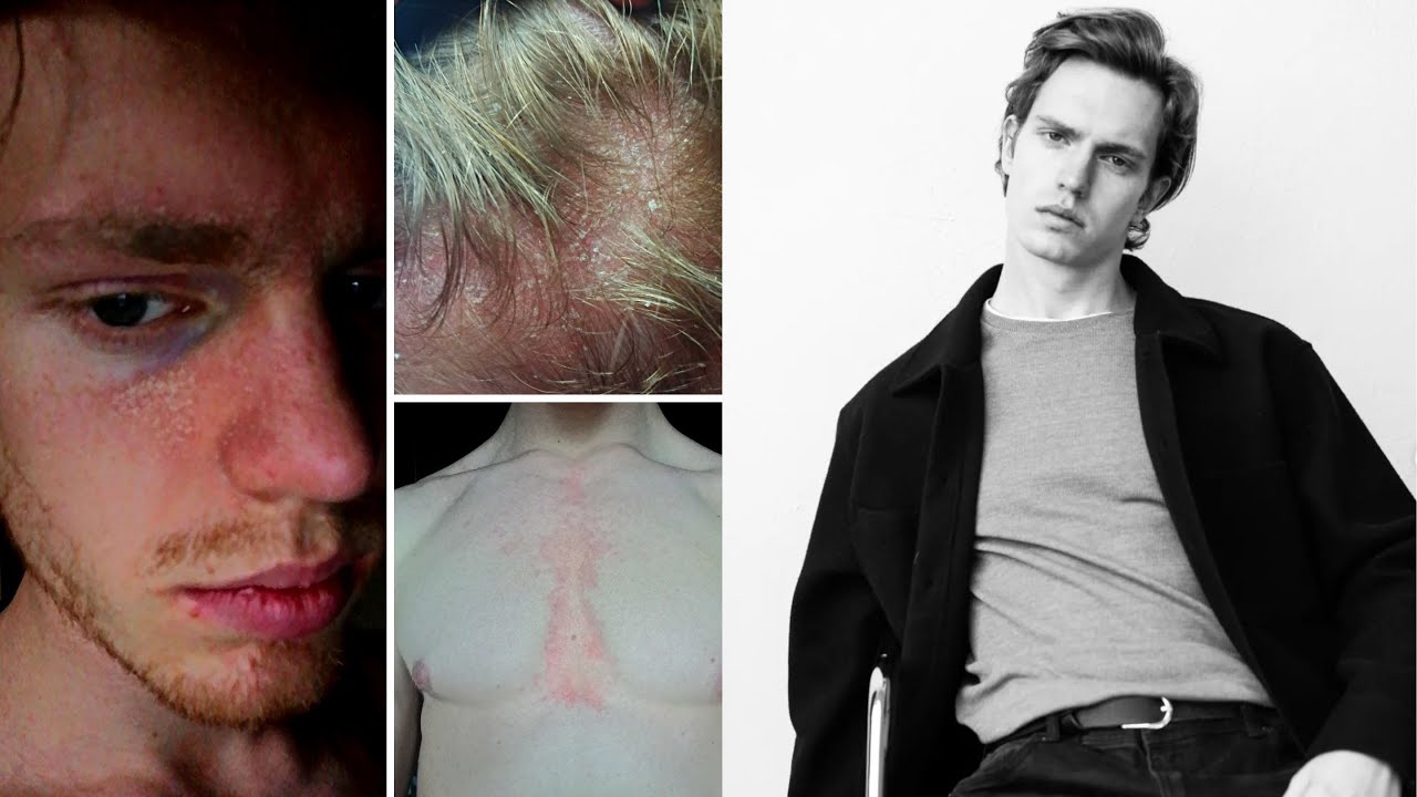 MODEL WITH ECZEMA - before and after the treatment - YouTube