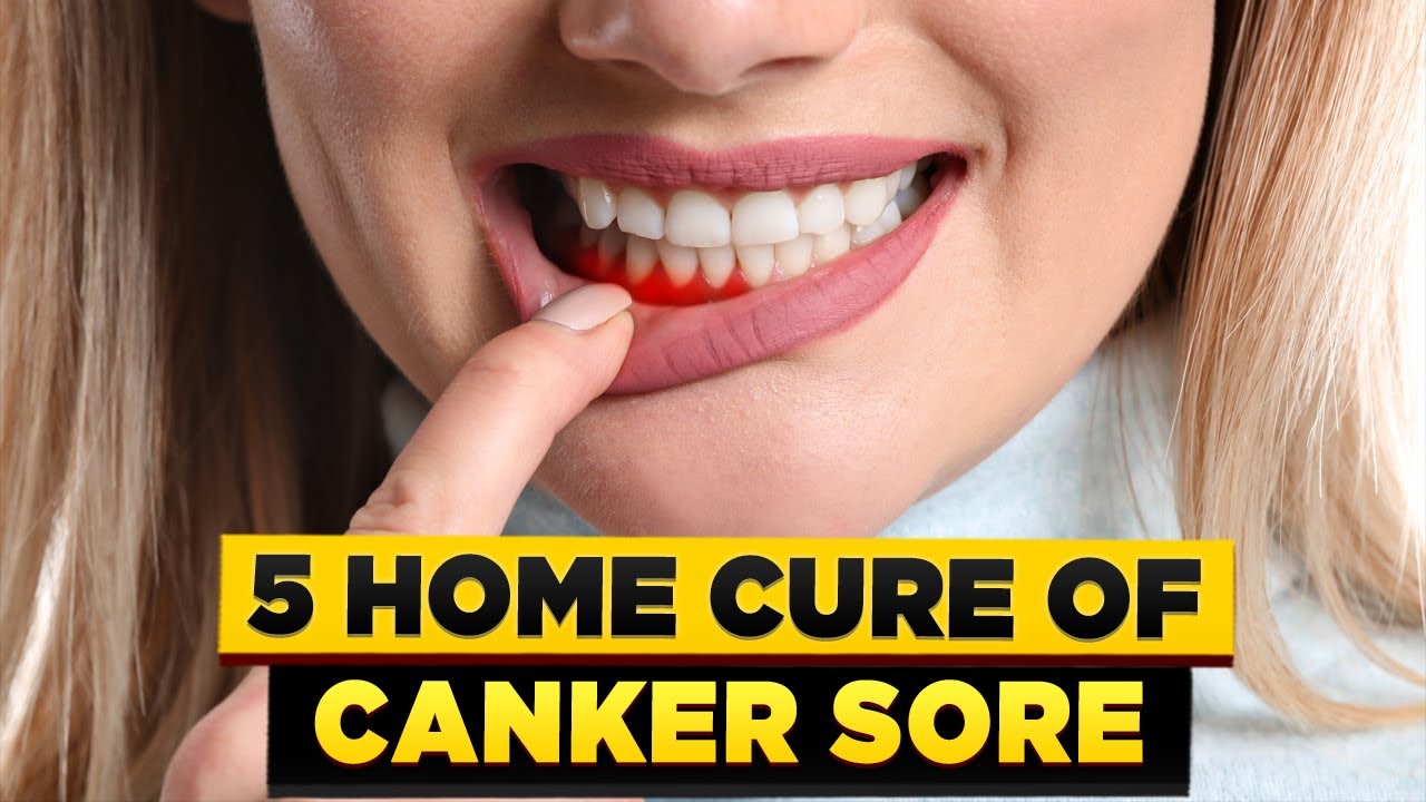 CANKER SORE Removal: 5 BULLETPROOF Canker Sore Home REMEDIES | Aphthous ...