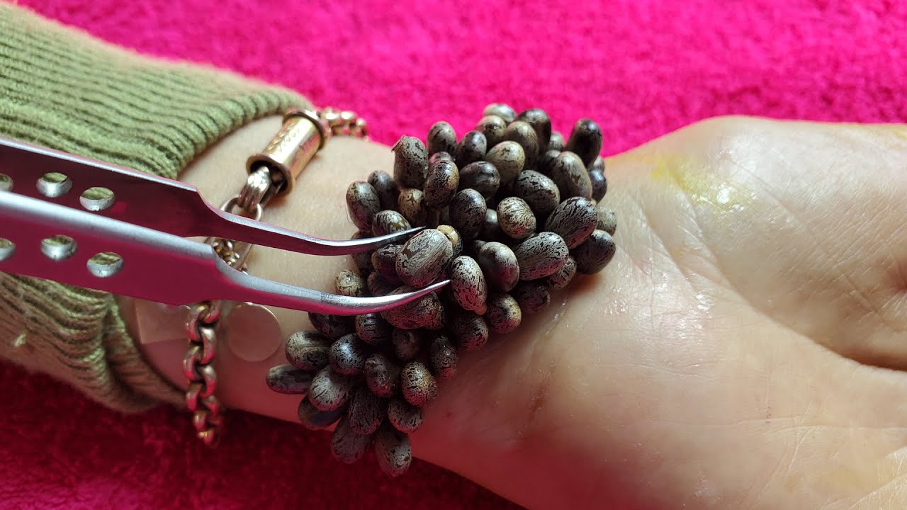 Remove strange ticks on hand - YouTube