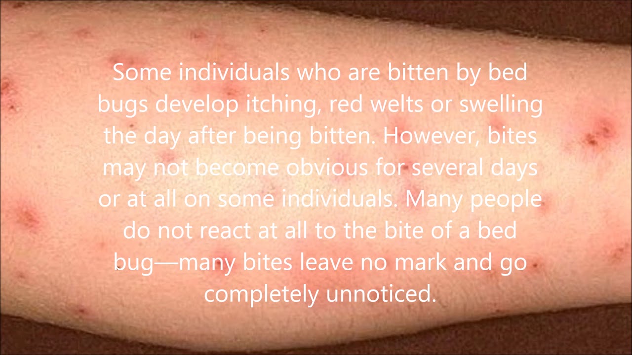 How To Identify Bed Bug Bites Orkin Canada