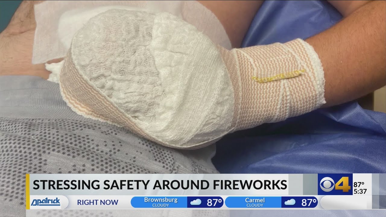 Surgeons save 3 fingers of boy injured in fireworks accident - YouTube