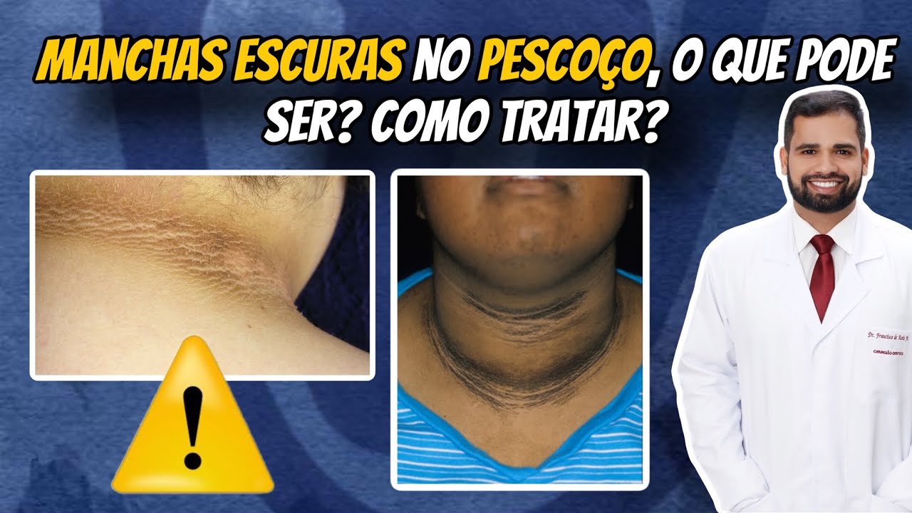Manchas escuras no pescoço, “lodo” no pescoço, o que pode ser? Como ...