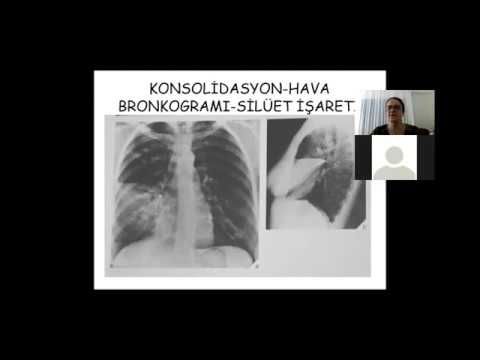 Akciğer röntgenogramı yorumlama dersi (II) - Prof. Dr. Göksel Altınışık Ergur- 07052020