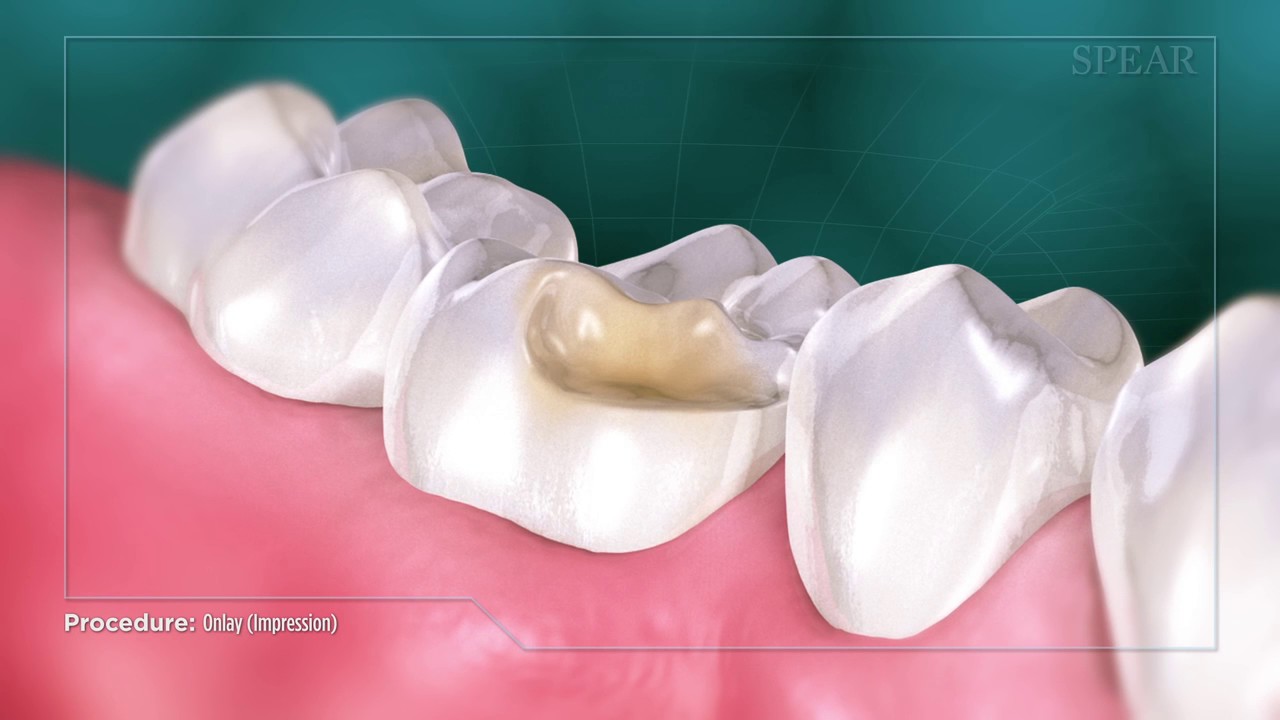 Onlay (Impression).flv - YouTube