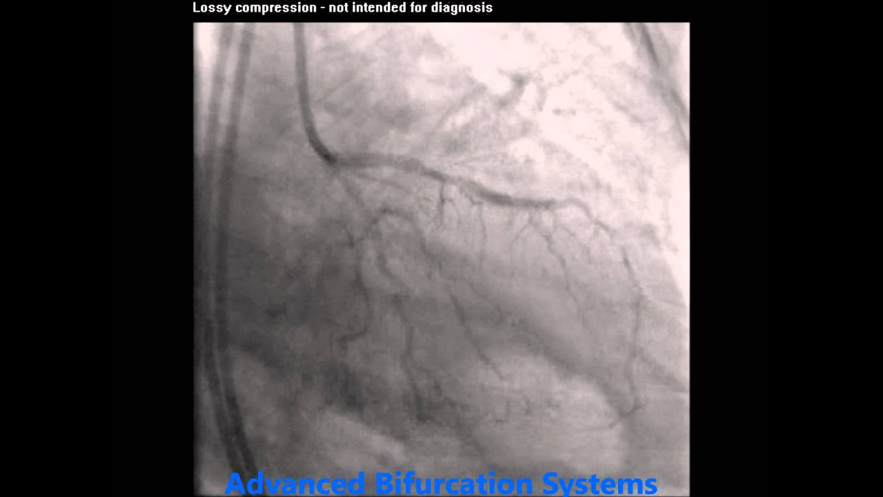 Pre LCx OM1 - Advanced Bifurcation Systems - YouTube