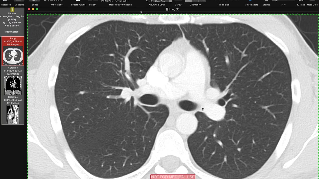 Lobar and Segmental Lung Anatomy on CT - YouTube