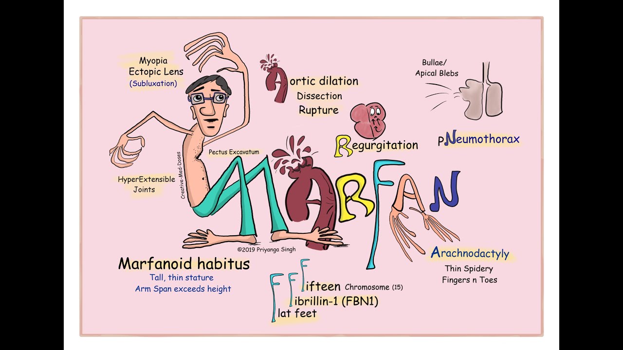Marfanoid habitus ; Definition, Causes, Characteristics, Symptoms ...