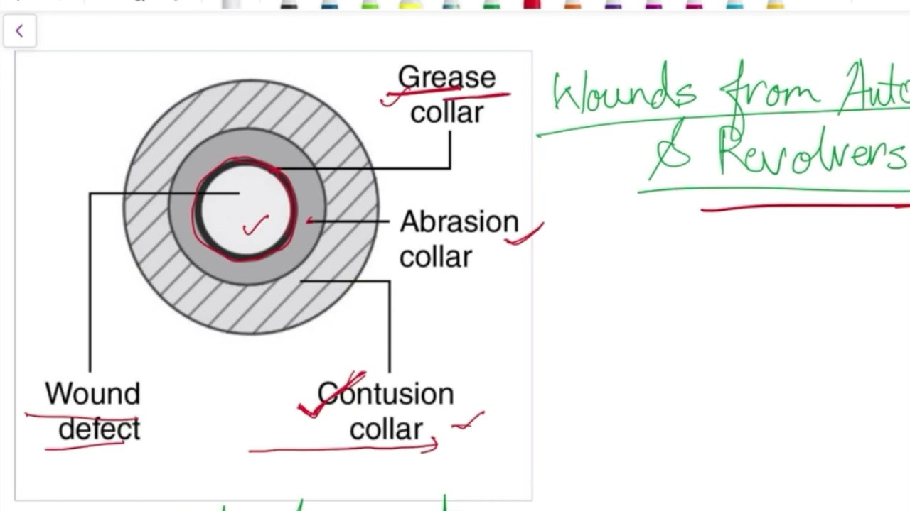 Abrasion Collar Gunshot Wound Entry