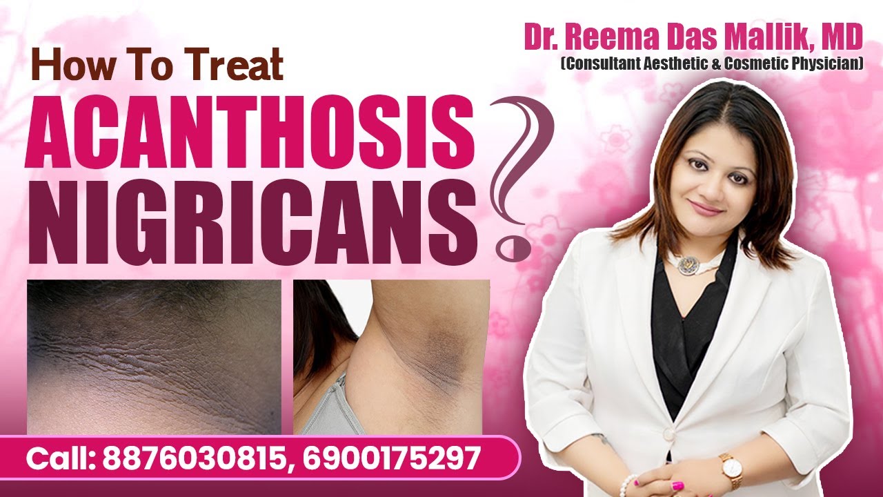 How To Treat ACANTHOSIS NIGRICANS ? || Dr. Reema Das Malik || 2024 ...