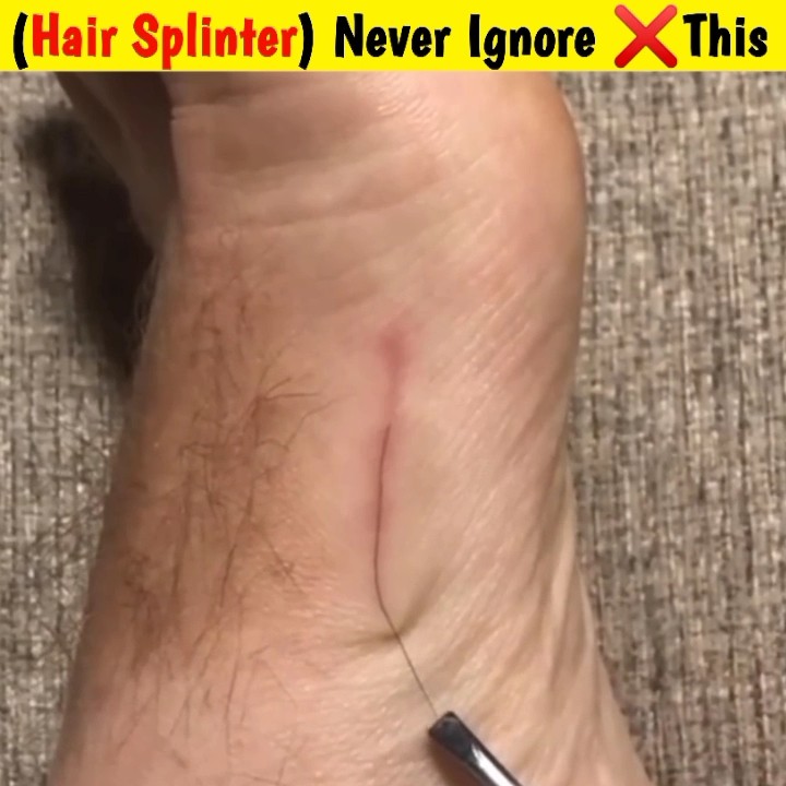 Hair Splinter 😨 | Never ignore this #facts #shorts #shortsfeed #short ...