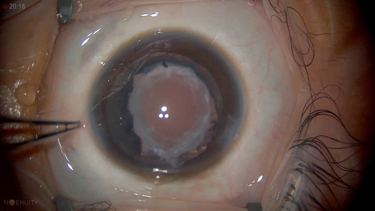 Surgery: Secondary Sulcus Fixated IOL Implantation - YouTube