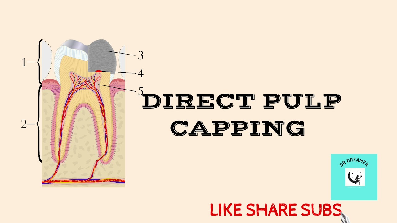 DIRECT PULP CAPPING - YouTube