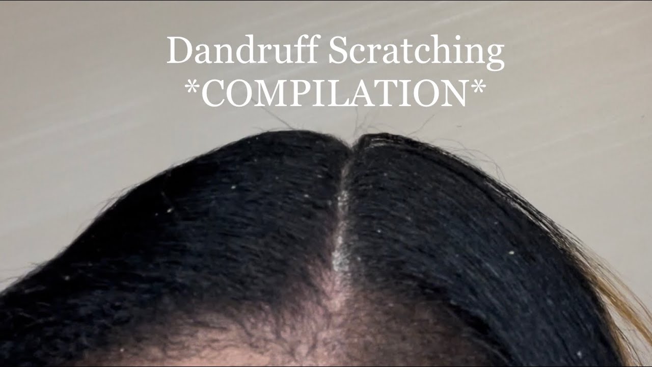 Dandruff Scratching Compilation - YouTube