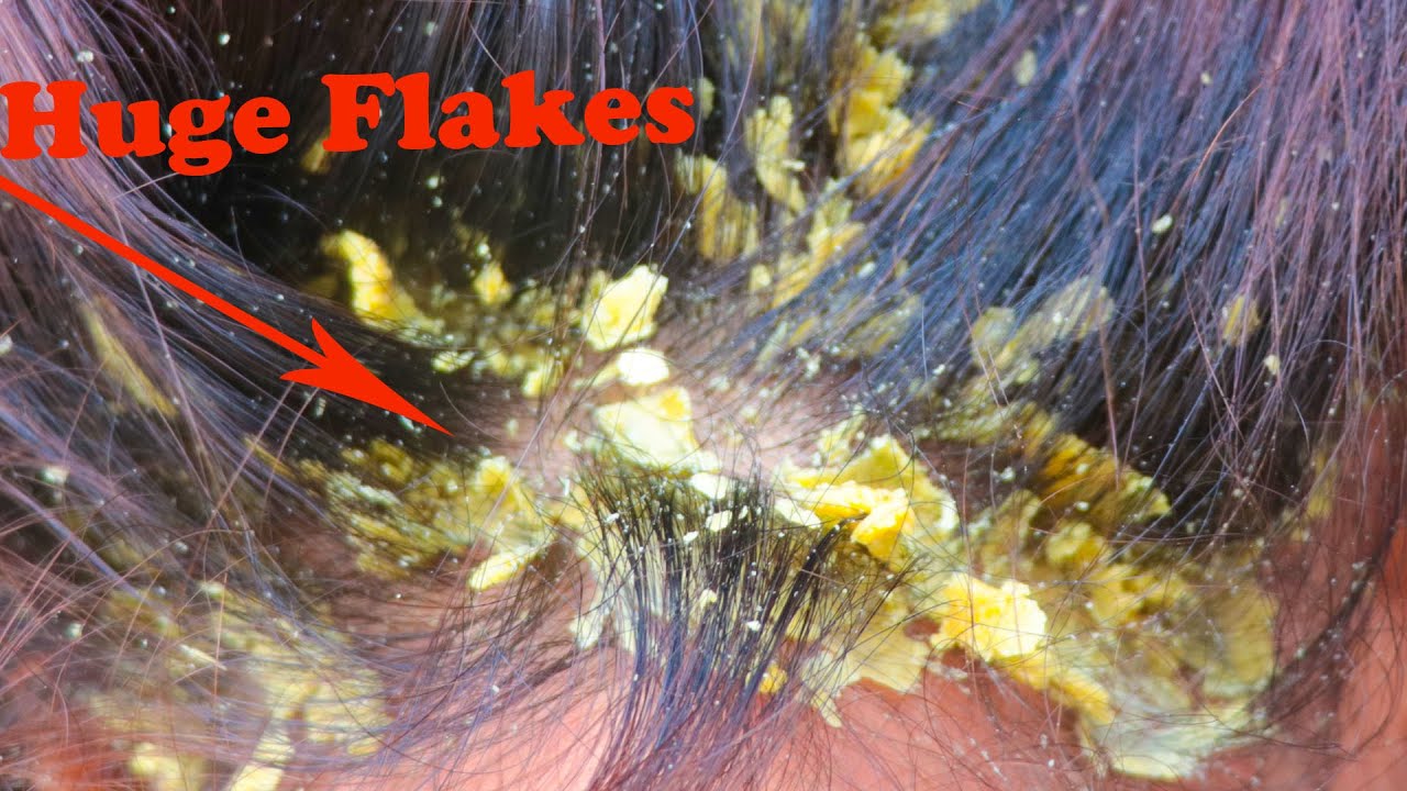 Dandruff combing # 152 BIG FLAKES!! Scratching Giant Itchy Flakes From ...