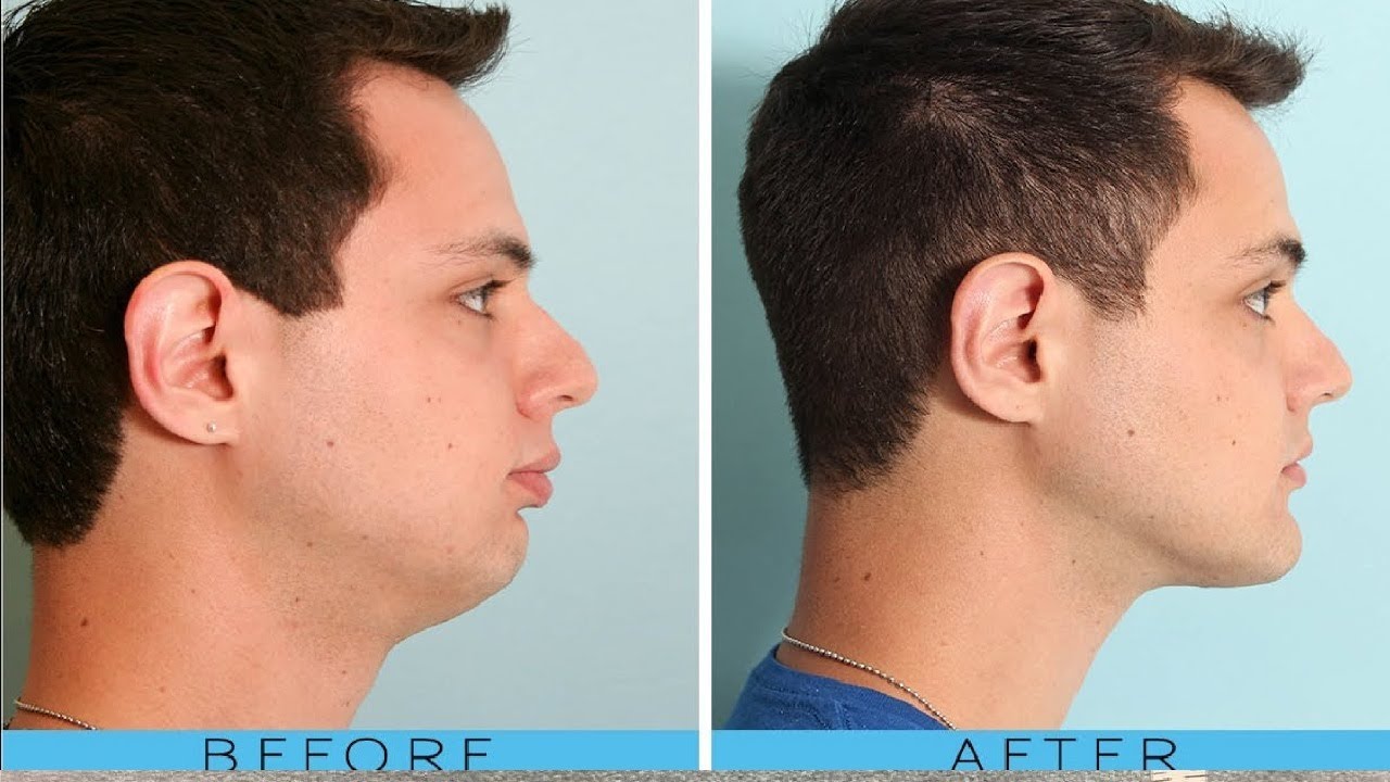 how to get rid of chubby cheeks best exercises - YouTube