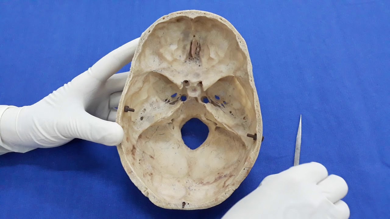 Interior of cranial vault and anterior cranial fossa - YouTube
