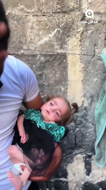 شاب من شمال غزة يبكي طفلته المُعرضة للموت بسبب الجوع ونقص التغذية شمال