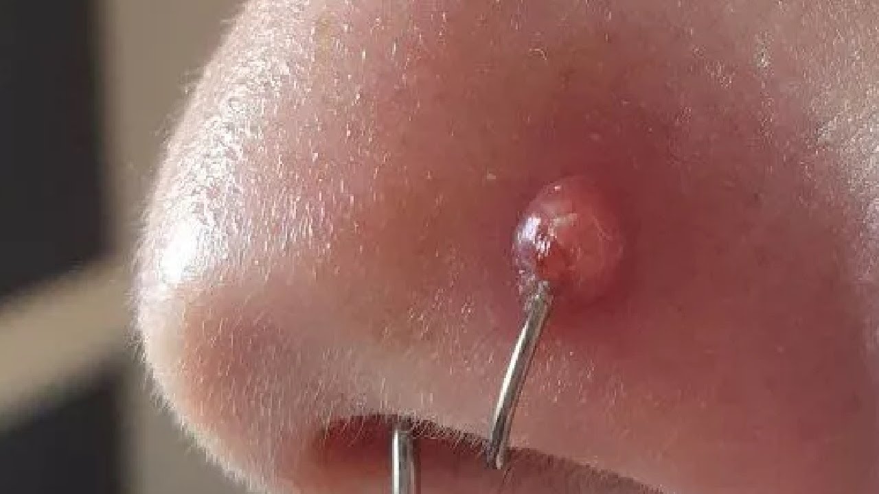 how to get rid of nose piercing scar tissue - YouTube