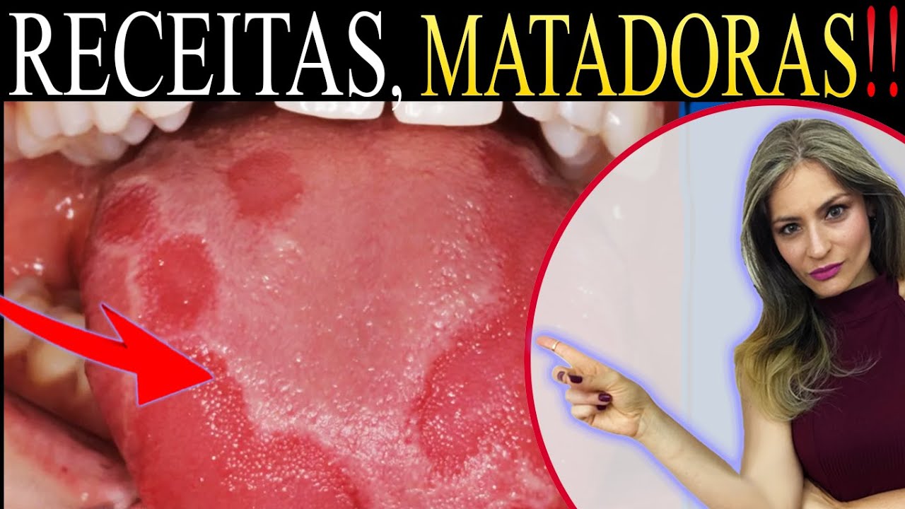 Candidiase Pseudomembranosa La Candidiasis Oral Dental Galindo