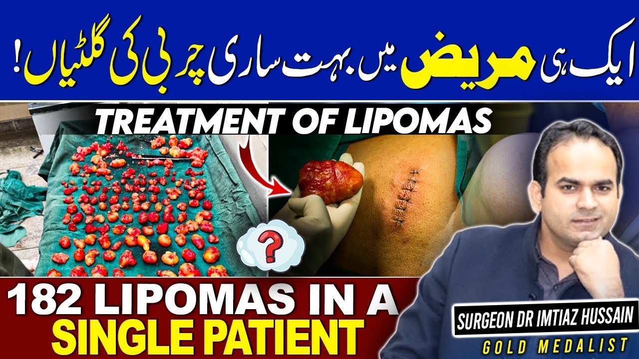 Surgical Removal of Multiple Lipomas in Dercum’s Disease | By Surgeon ...