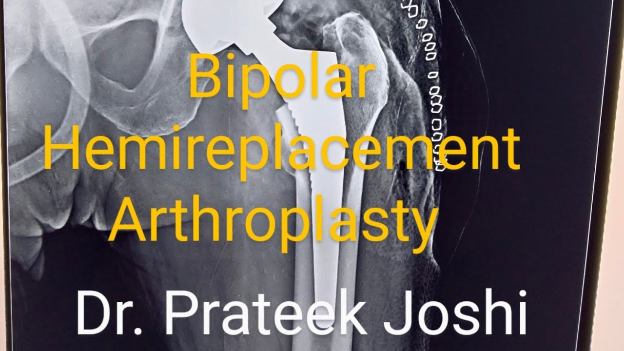 Uncemented Bipolar Hemi Replacement Arthroplasty Hip for Neck of Femur ...