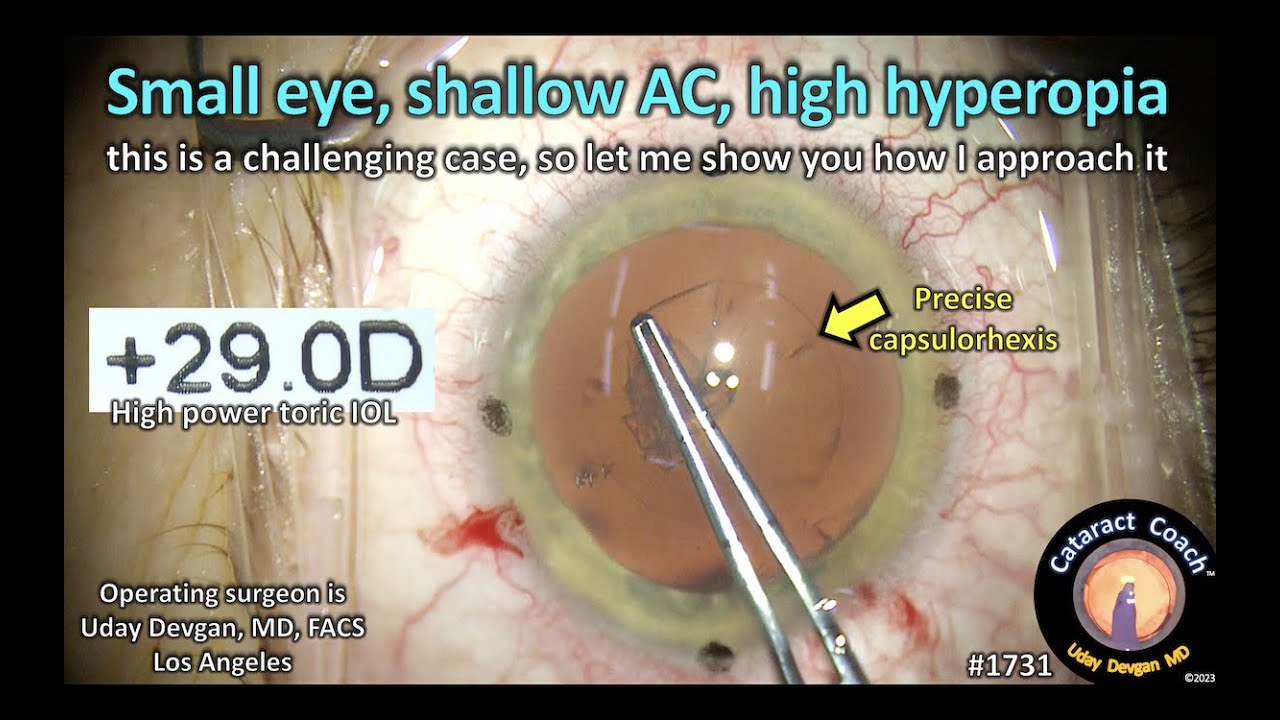 CataractCoach™1731: small eye, shallow AC, high hyperopia - YouTube