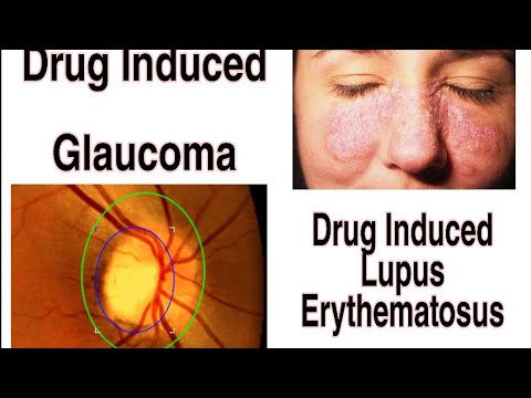Drug Induced Lupus Erythematosus | Drug Induced Glaucoma | Drug Induced ...