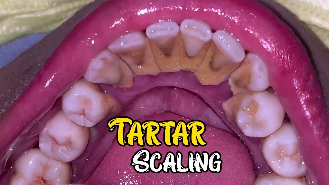 Deep Cleaning With HEAVY Tartar Build Up At The Dentist - YouTube
