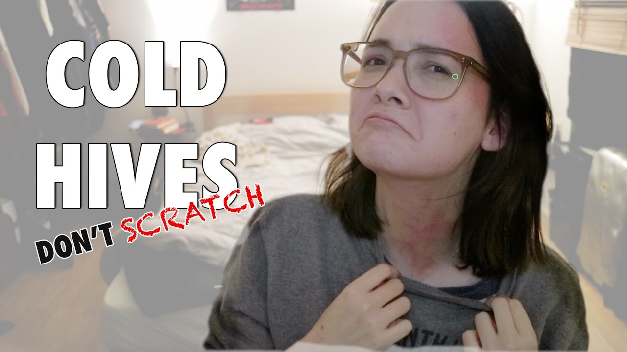 Itchy Itchy Urticaria aka. Cold Hives | ASHA ETC - YouTube