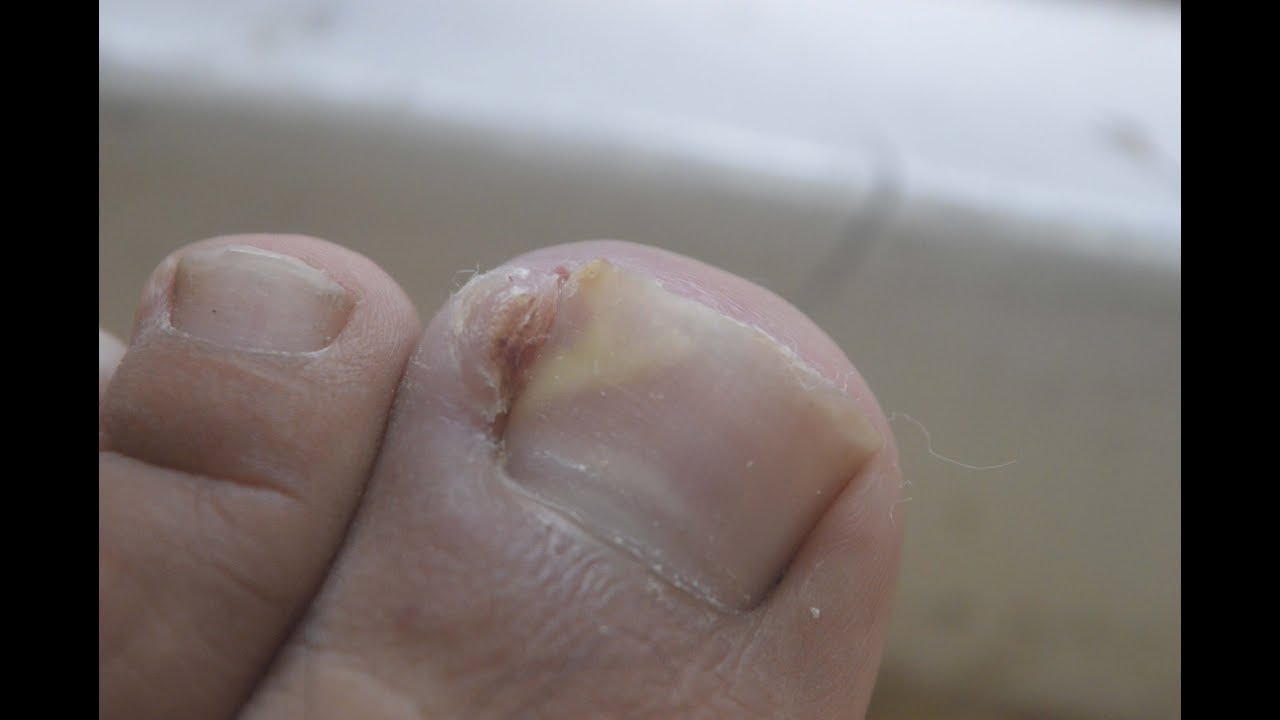 How to cure ingrown nails. Cleaning ingrown nails. High Quality Video ...