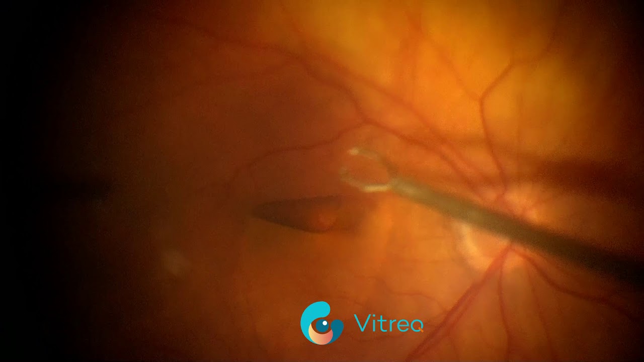 Vitreq 27G ILM Forceps long - YouTube