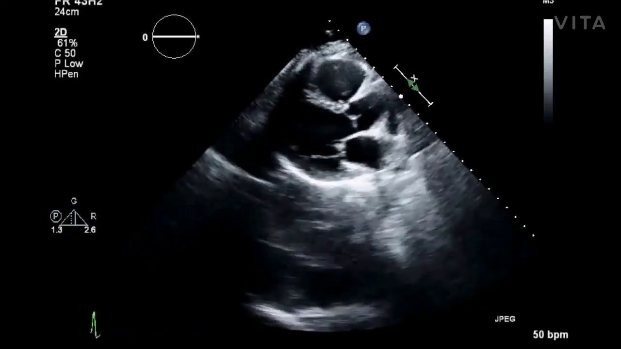Standard 2-d Echocardiogram protocol - YouTube
